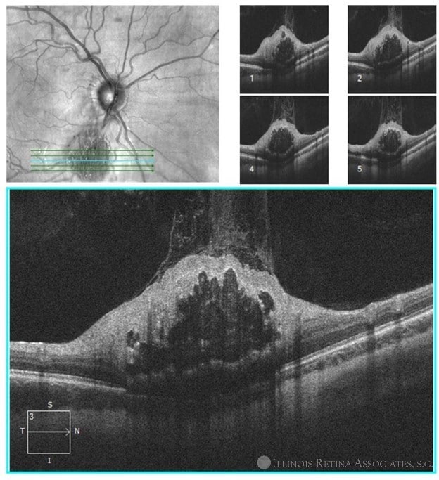 Astrocytic Hamartoma – May 2021 | Illinois Retina Associates™: Top ...