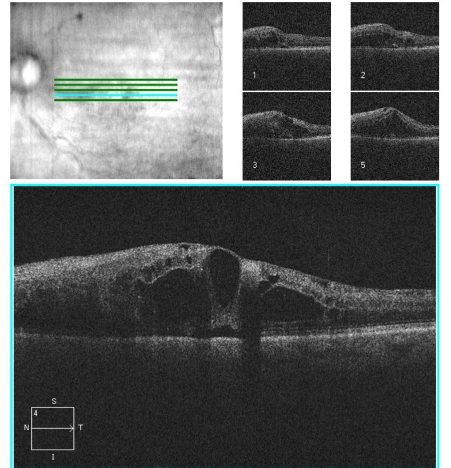 Branch Retinal Vein Occlusion – November 2020 | Illinois Retina ...