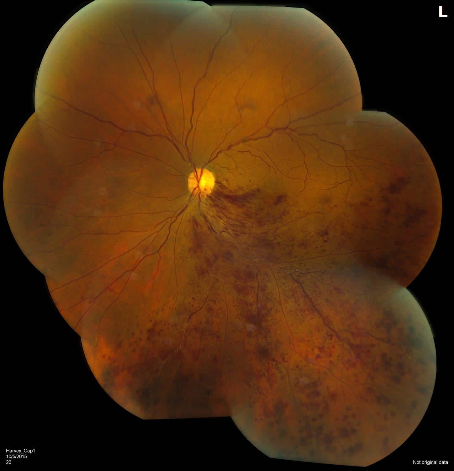 Branch Retinal Vein Occlusion – November 2020 | Illinois Retina ...