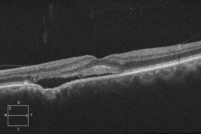 Focal Choroidal Excavation – December 2018 | Illinois Retina Associates ...