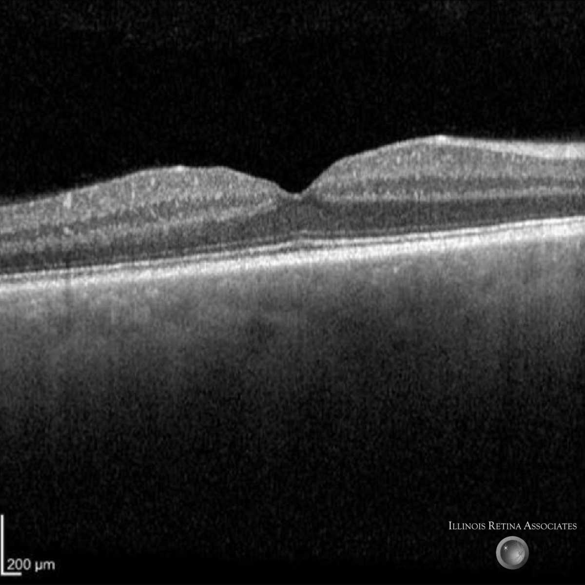 Angioid Streaks – September, 2023
