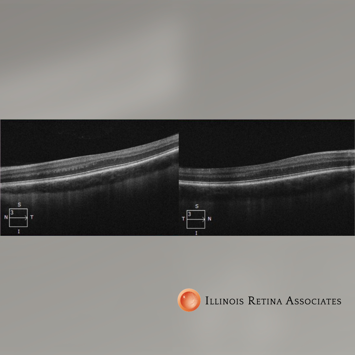 Multiple Evanescent White Dot Syndrome (MEWDS) – January, 2024