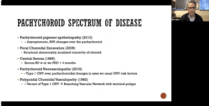 Dr. Chaturvedi Gives Lecture On Pachychoroid Spectrum Of Macular ...