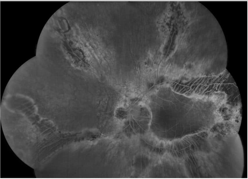 Pigmented Paravenous Retinochoroidal Atrophy – May 2020 | Illinois ...