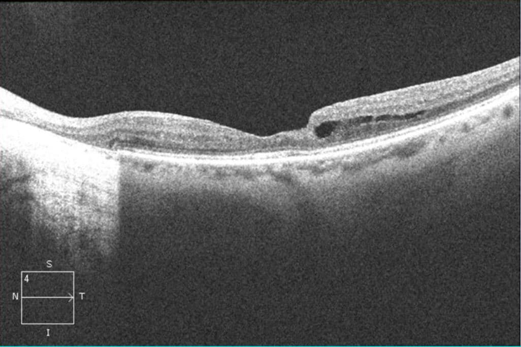 Pigmented Paravenous Retinochoroidal Atrophy – May 2020 | Illinois ...
