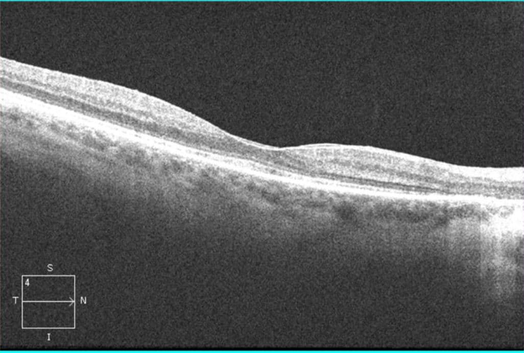 Pigmented Paravenous Retinochoroidal Atrophy – May 2020 | Illinois ...
