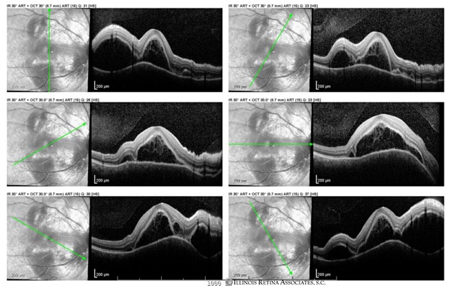 Posterior Scleritis – January, 2022 | Illinois Retina Associates™: Top ...