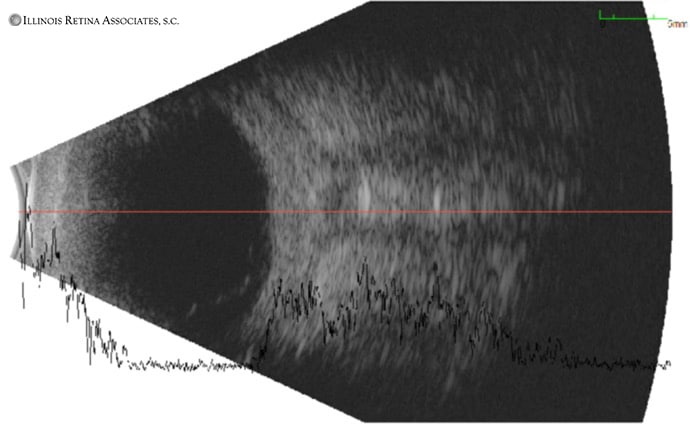 Posterior Scleritis – January, 2022 | Illinois Retina Associates™: Top ...