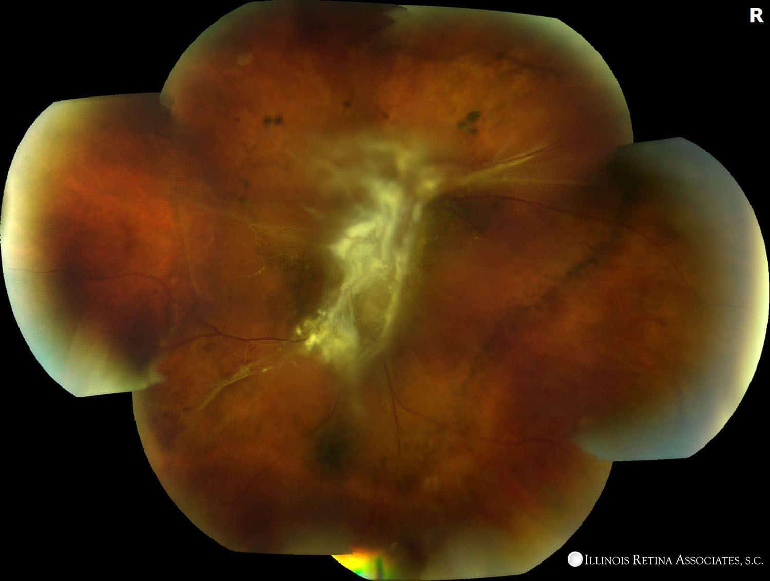Proliferative Diabetic Retinopathy – August, 2021 | Illinois Retina ...