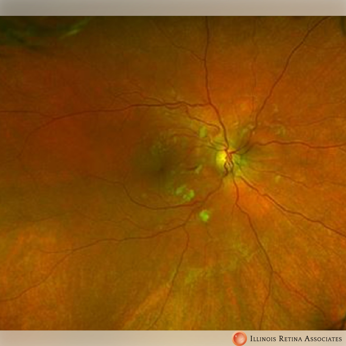 Multiple Evanescent White Dot Syndrome (MEWDS) – January, 2024