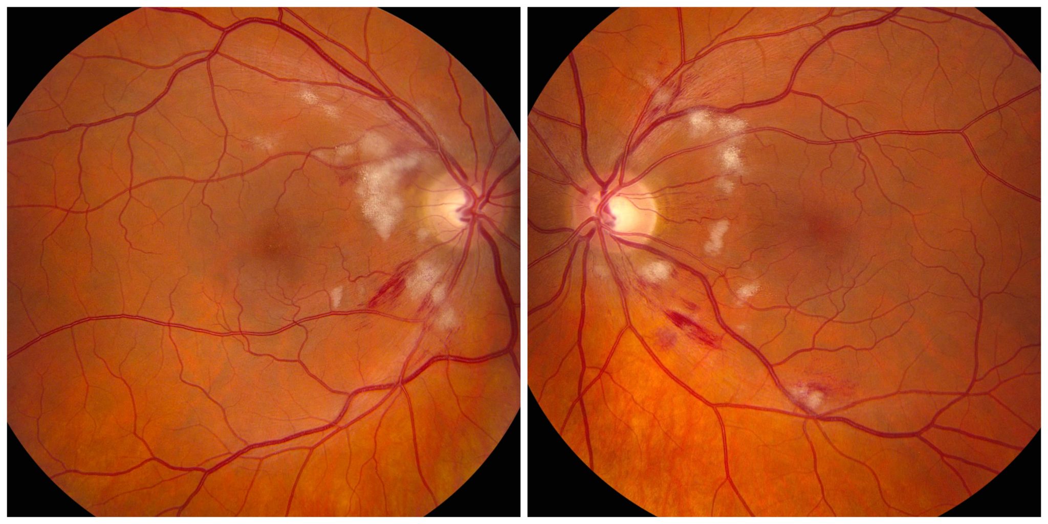 Putscher’s Retinopathy – July 2018 | Illinois Retina Associates™: Top ...