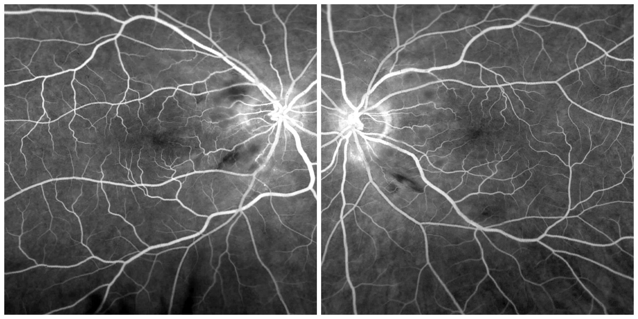 Putscher’s Retinopathy – July 2018 | Illinois Retina Associates™: Top ...