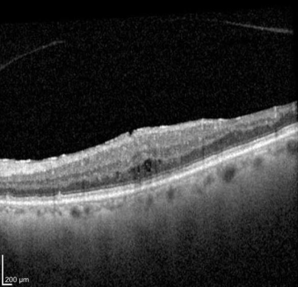 Multiple Evanescent White Dot Syndrome (MEWDS) – January, 2024