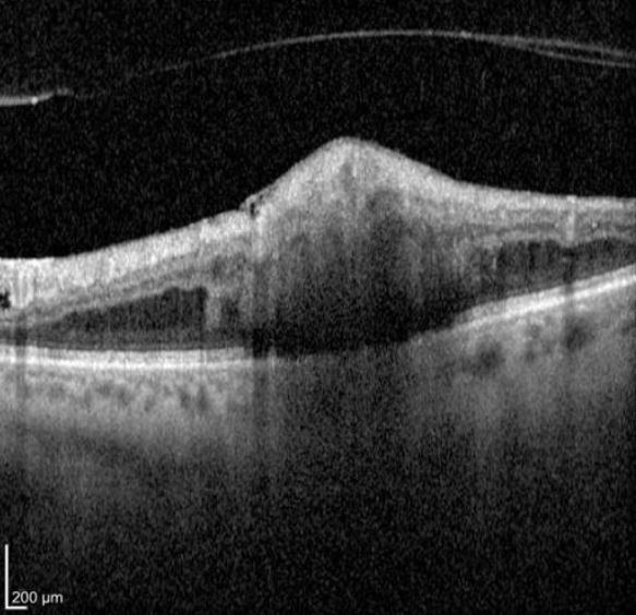Multiple Evanescent White Dot Syndrome (MEWDS) – January, 2024