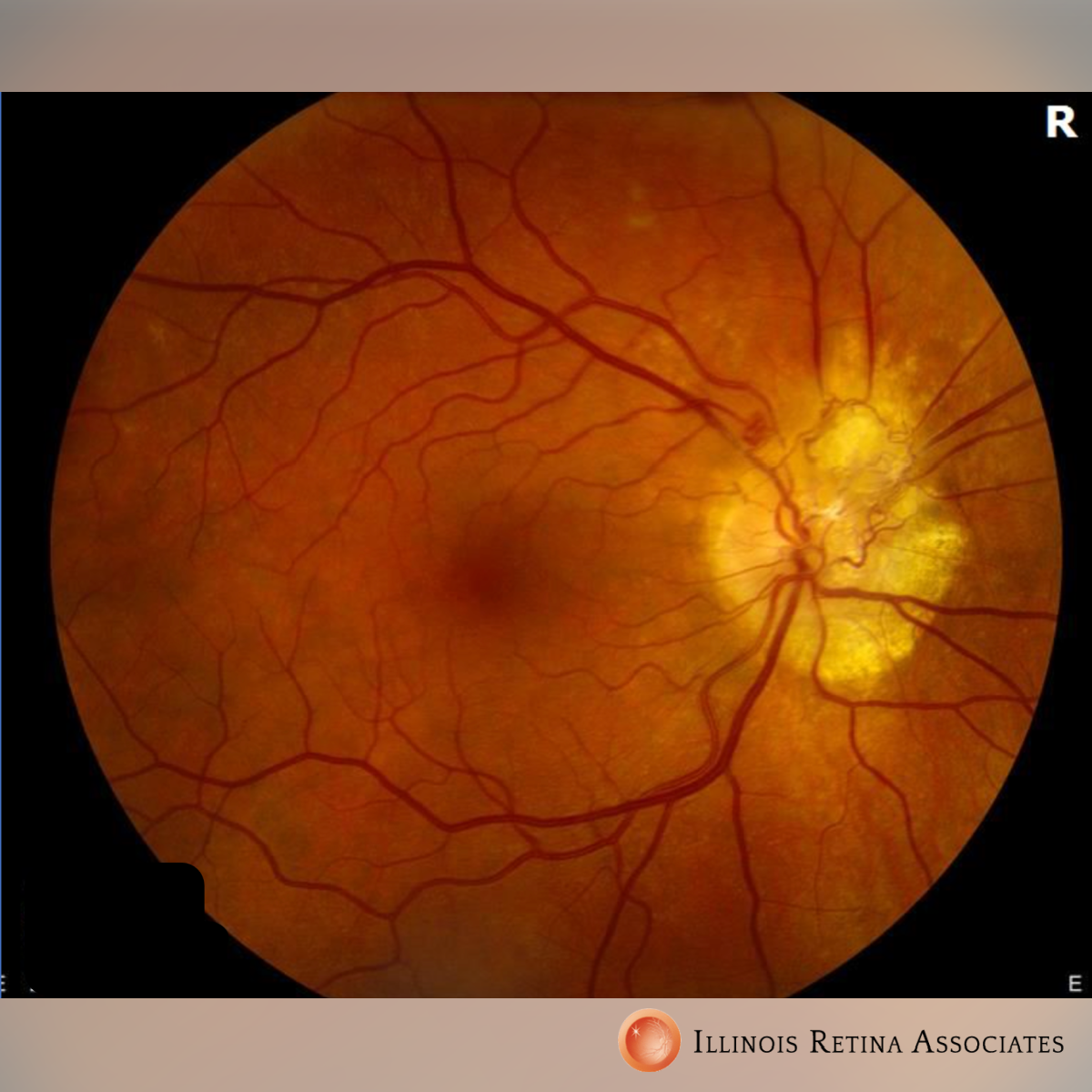 Angioid Streaks – September, 2023