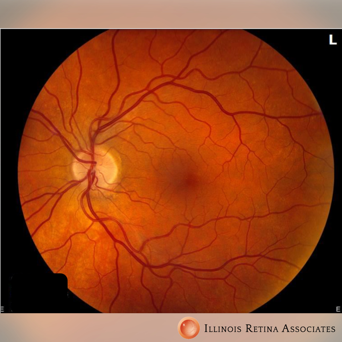 Angioid Streaks – September, 2023