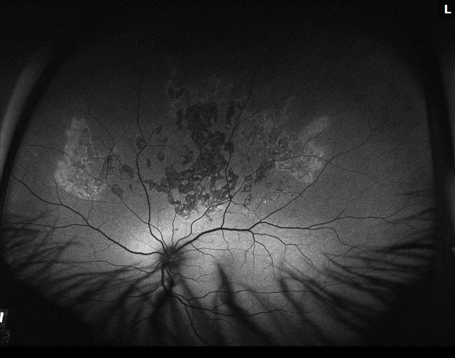 Serpiginous Choroiditis – September 2020 | Illinois Retina Associates ...