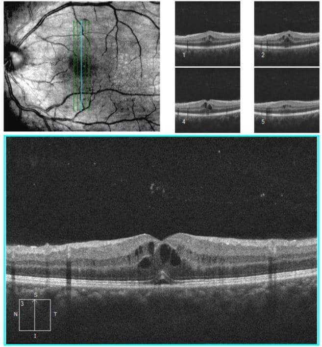 Serpiginous Choroiditis – September 2020 | Illinois Retina Associates ...