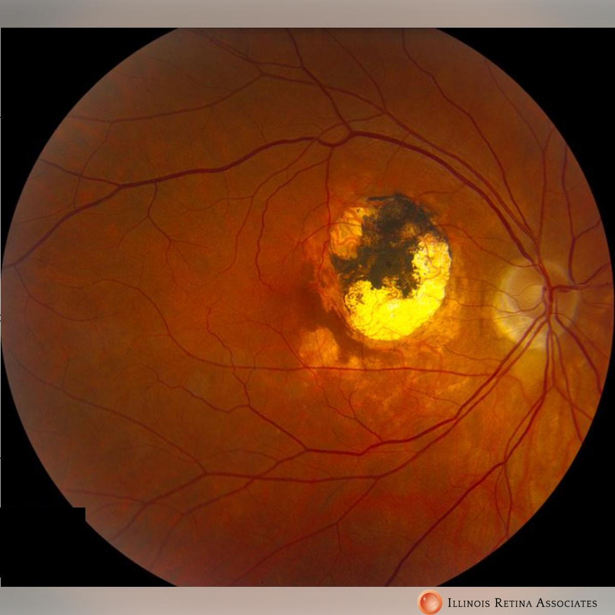 Multiple Evanescent White Dot Syndrome (MEWDS) – January, 2024