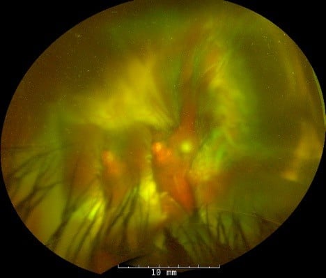 Suprachoroidal Hemorrhage – June, 2020 | Illinois Retina Associates ...