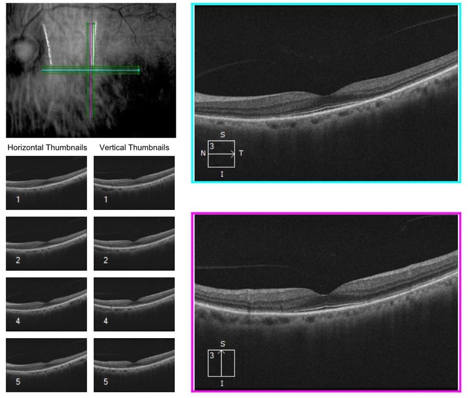 Unilateral Plaquenil Toxicity – March 2021 | Illinois Retina Associates ...