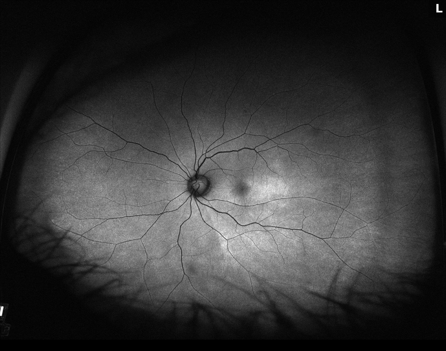 Unilateral Plaquenil Toxicity – March 2021 | Illinois Retina Associates ...