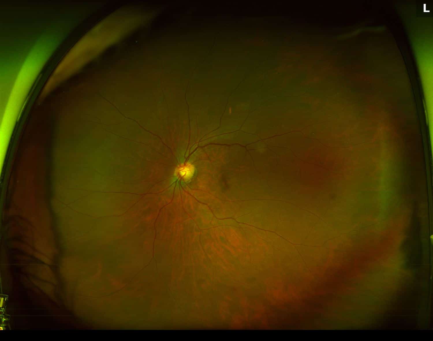 Unilateral Plaquenil Toxicity – March 2021 | Illinois Retina Associates ...