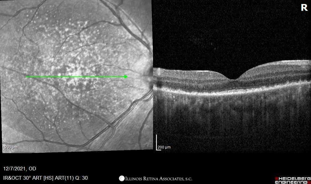 Vogt-Koyanagi-Harada Disease (VKH) – December, 2021 | Illinois Retina ...