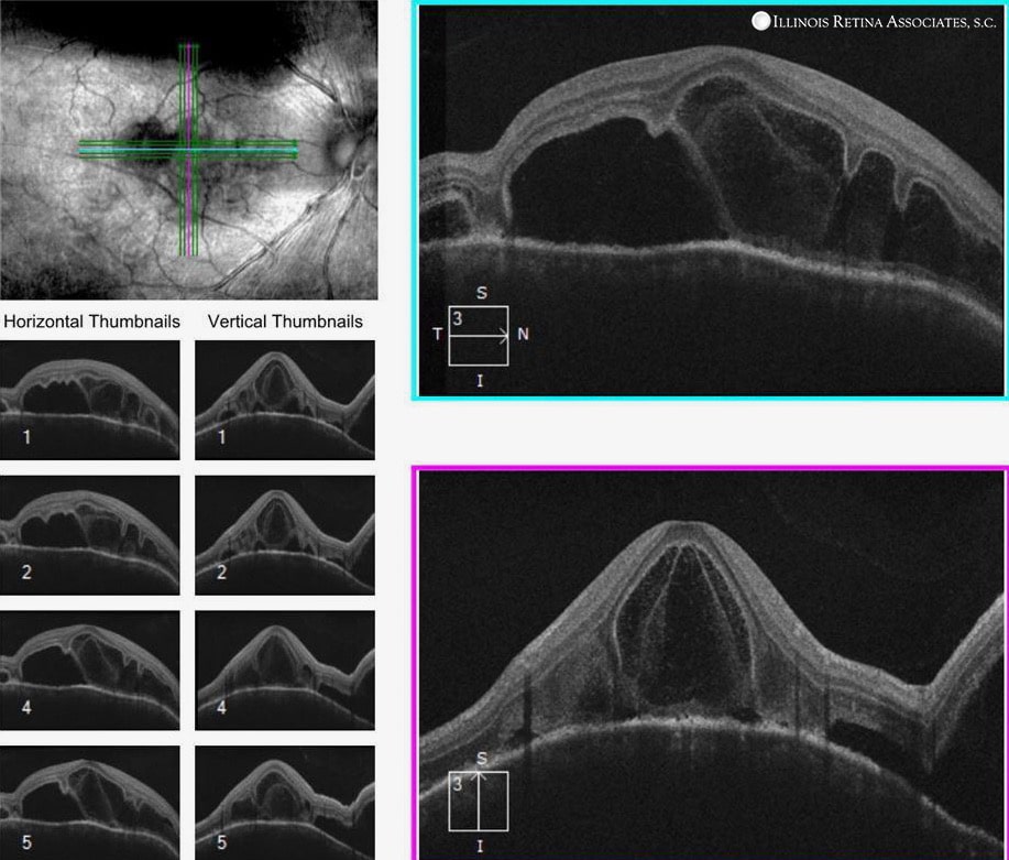 Vogt-Koyanagi-Harada Disease (VKH) – December, 2021 | Illinois Retina ...