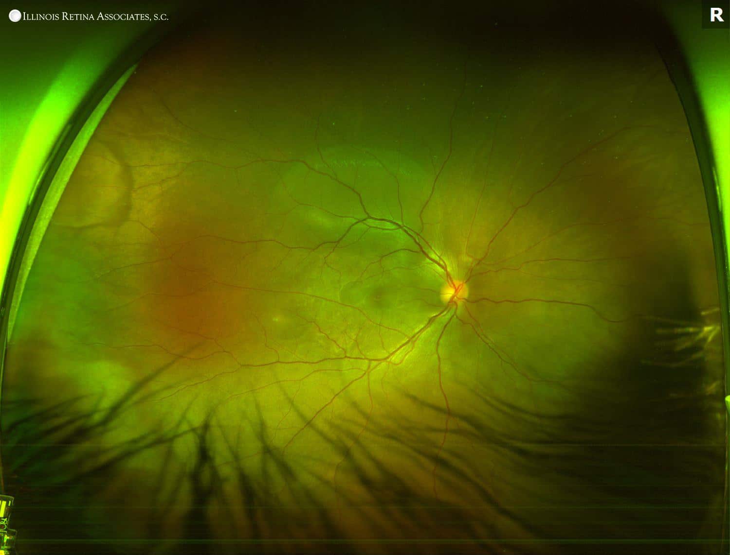 Vogt-Koyanagi-Harada Disease (VKH) – December, 2021 | Illinois Retina ...