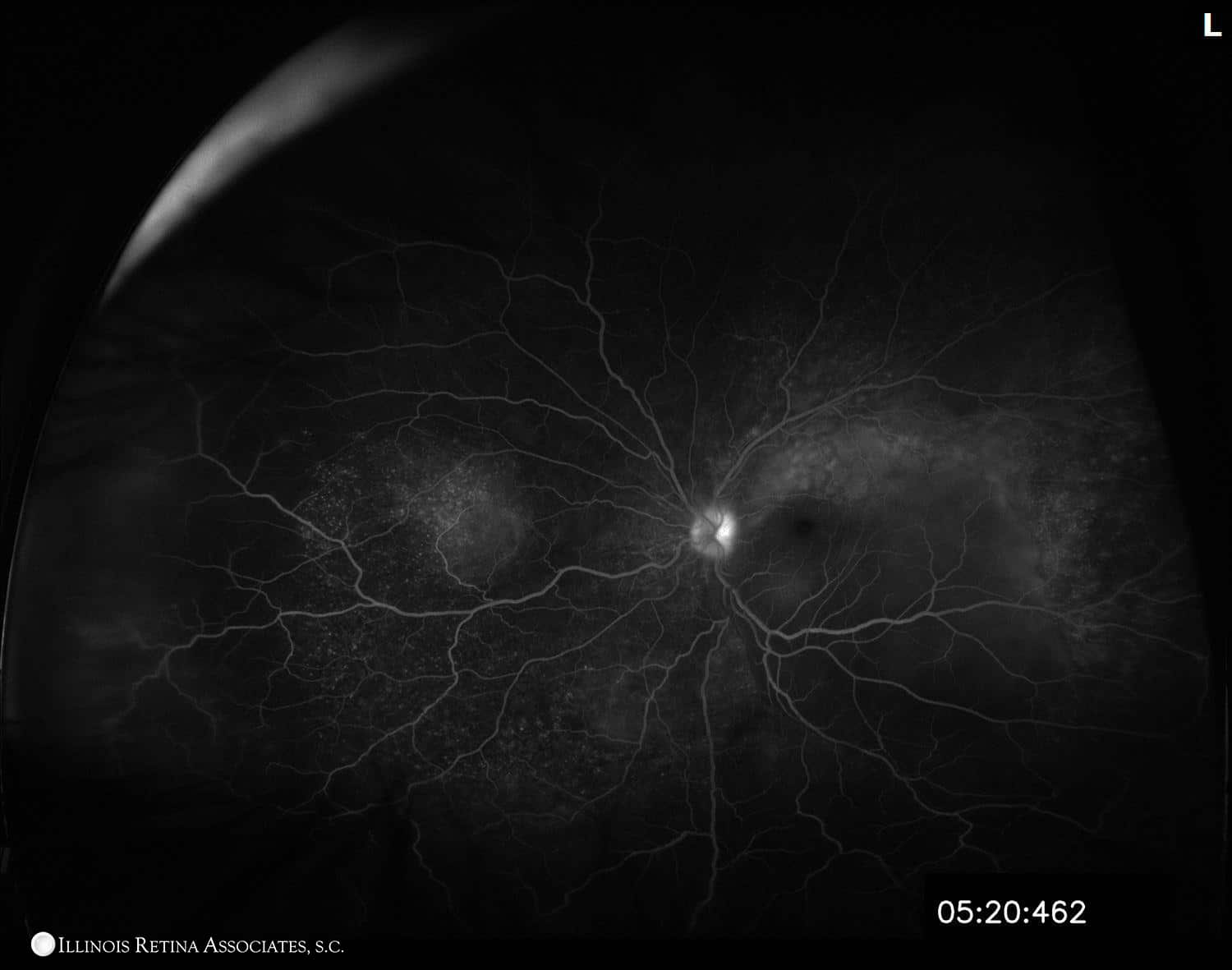 Vogt-Koyanagi-Harada Disease (VKH) – December, 2021 | Illinois Retina ...