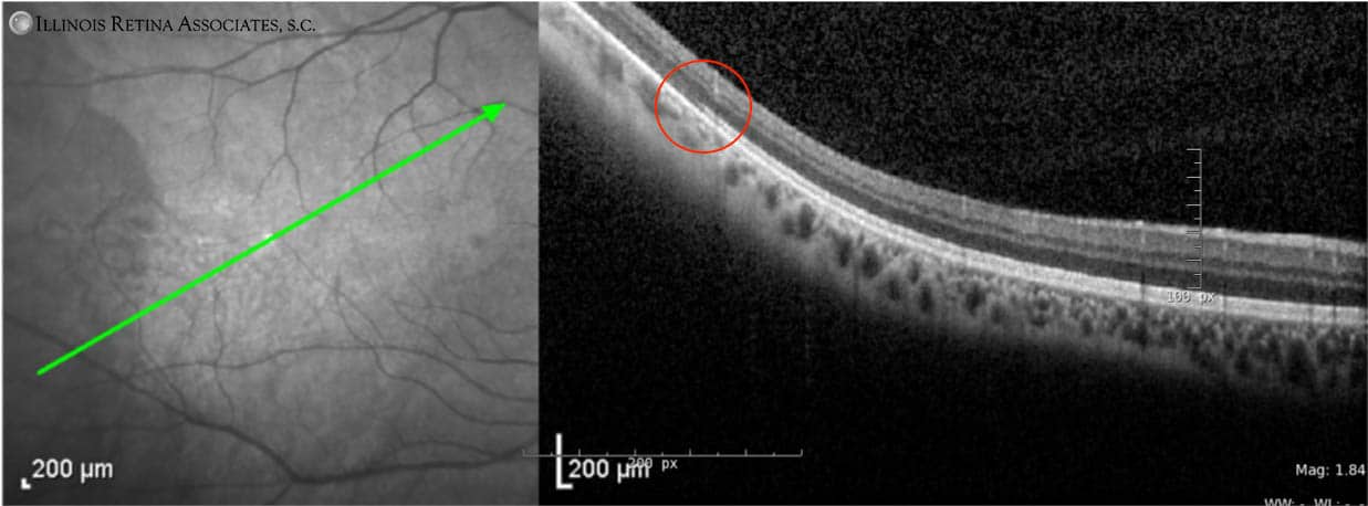 White Without Pressure – November, 2021 | Illinois Retina Associates ...