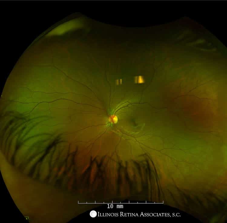 White Without Pressure – November, 2021 | Illinois Retina Associates ...